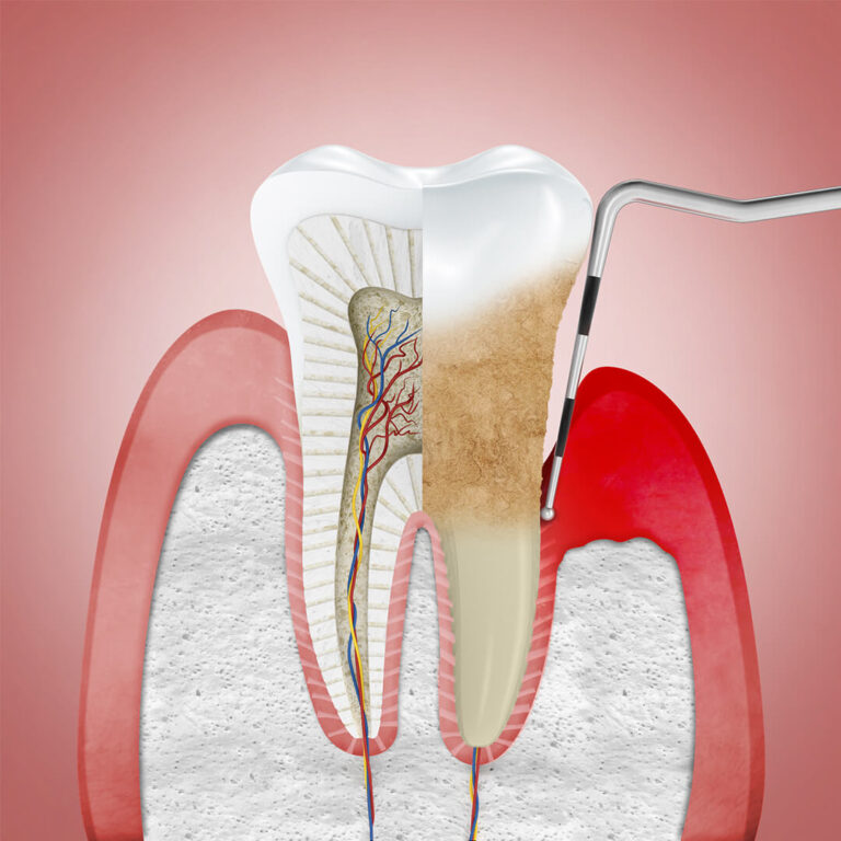Periodontal Treatment - Cornerstone Dental