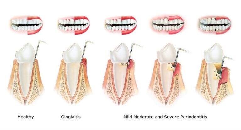 Periodontal Treatment - Cornerstone Dental